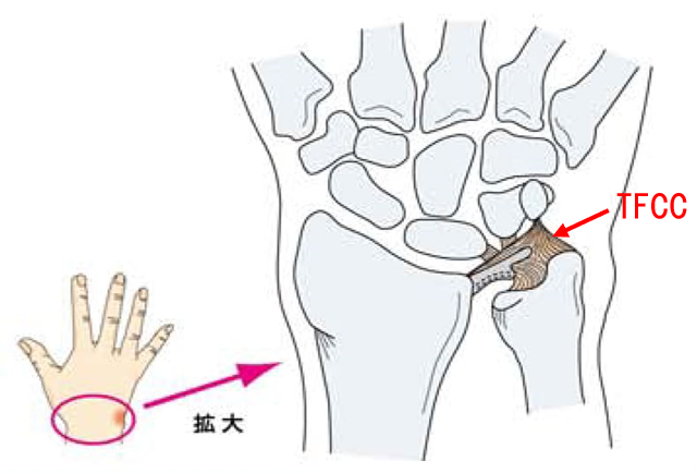 TFCC損傷 ｜京都市西京区の桂東洋鍼灸整骨院